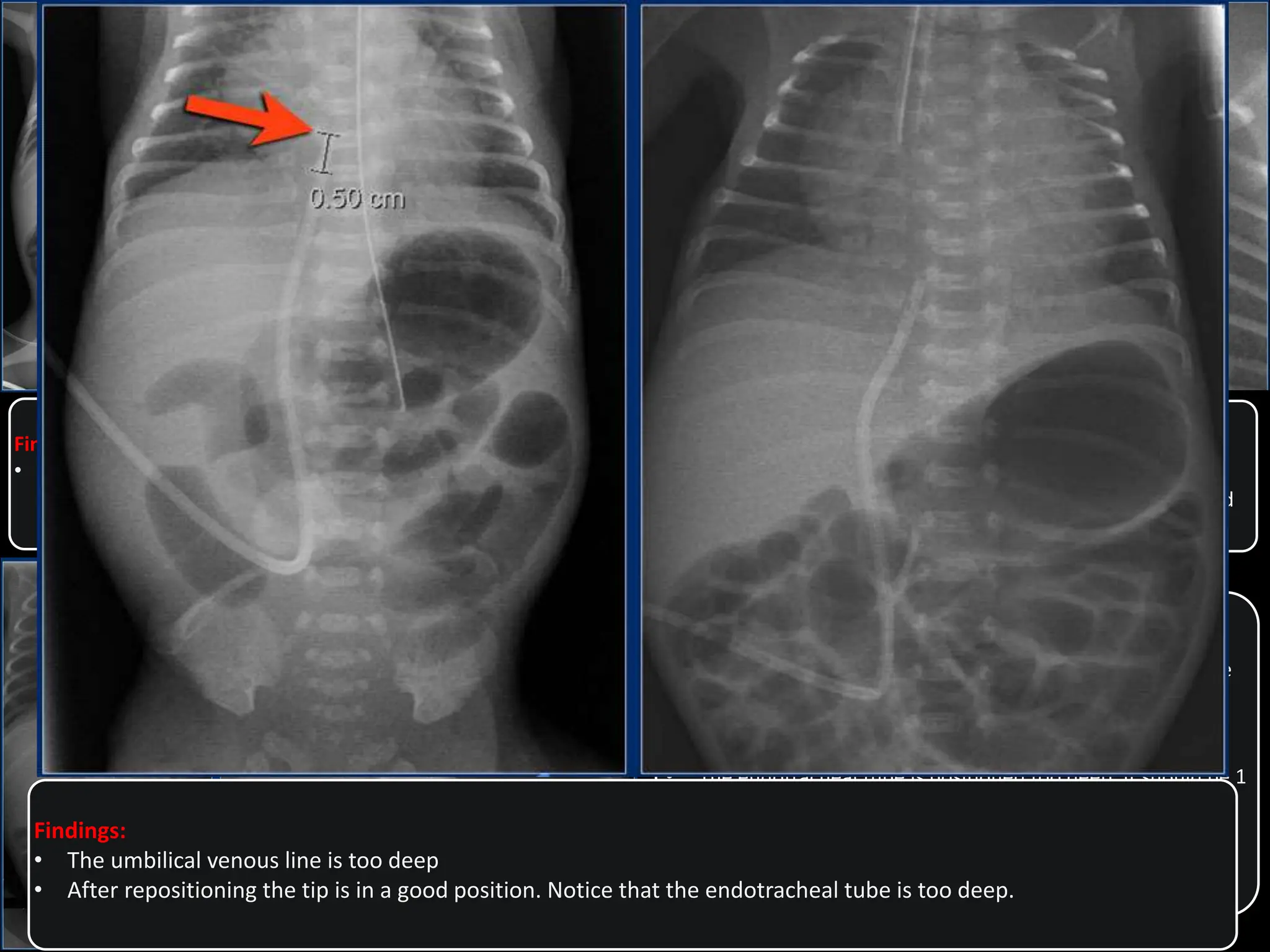 The Neonatal chest dr.xay.pptx