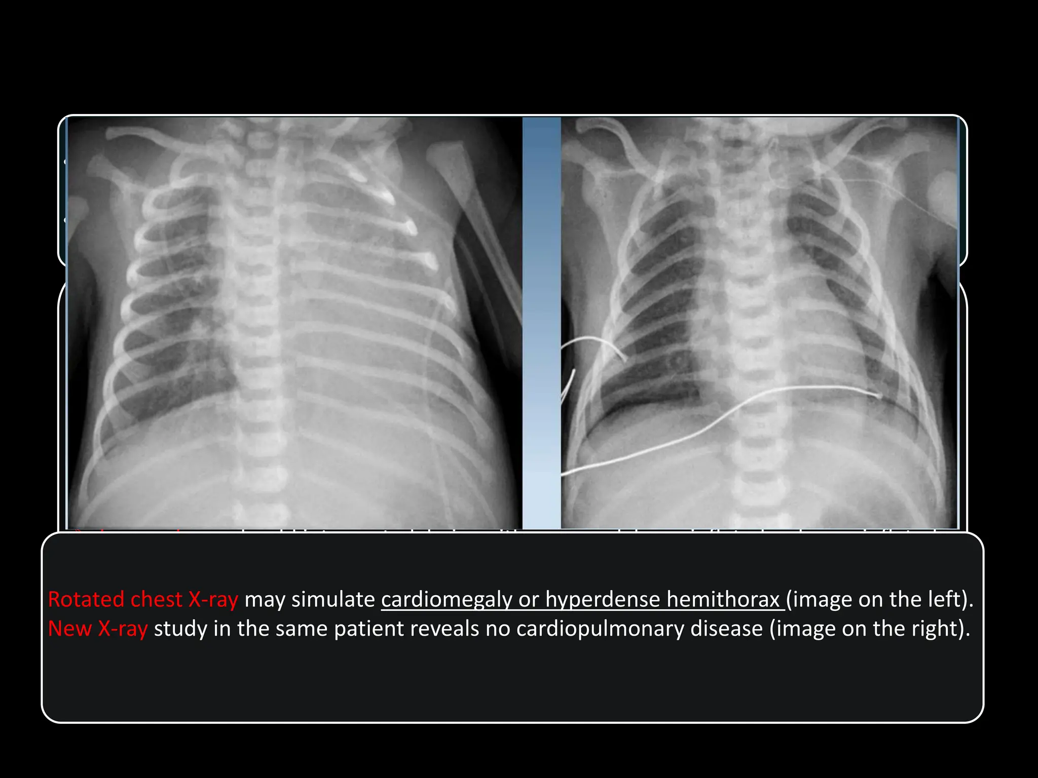 The Neonatal chest dr.xay.pptx