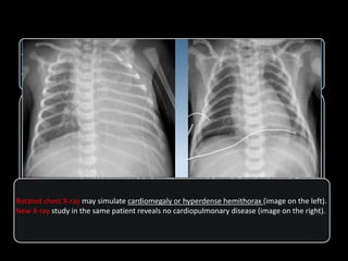 The Neonatal chest dr.xay.pptx