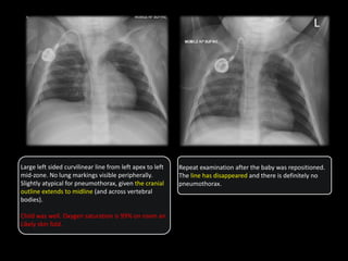 The Neonatal chest dr.xay.pptx