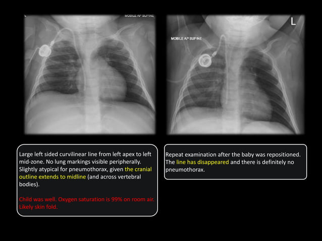 The Neonatal chest dr.xay.pptx