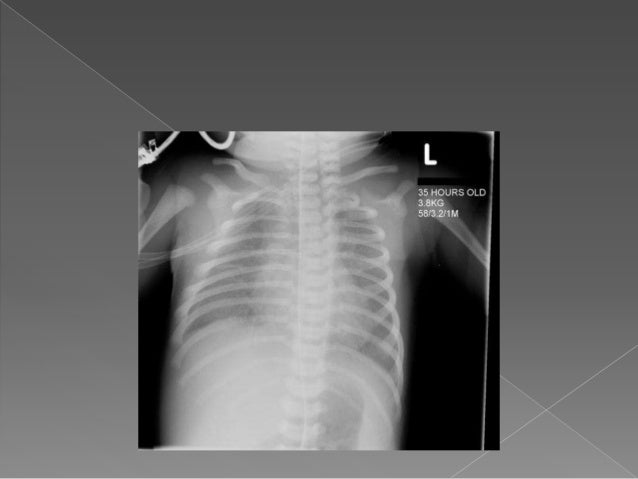 Neonatal chest x ray reading