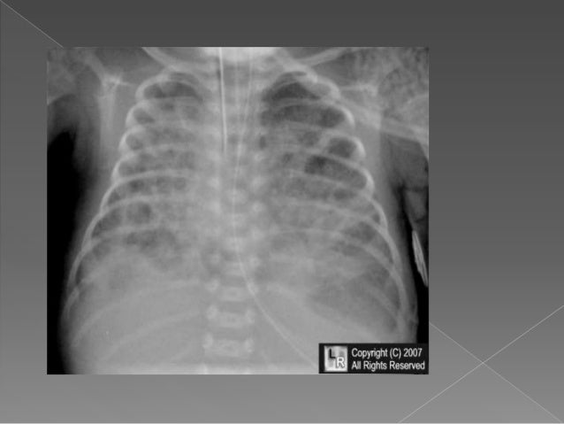 Neonatal chest x ray reading