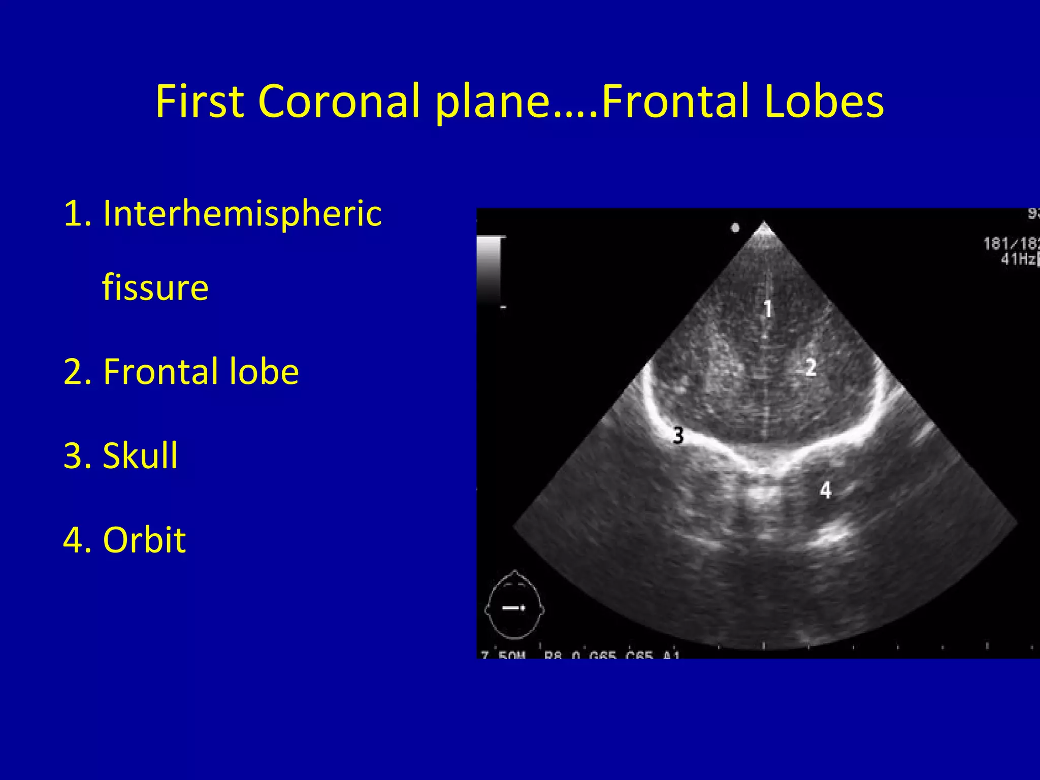 Cranial Ultrasound of neonate | PPT