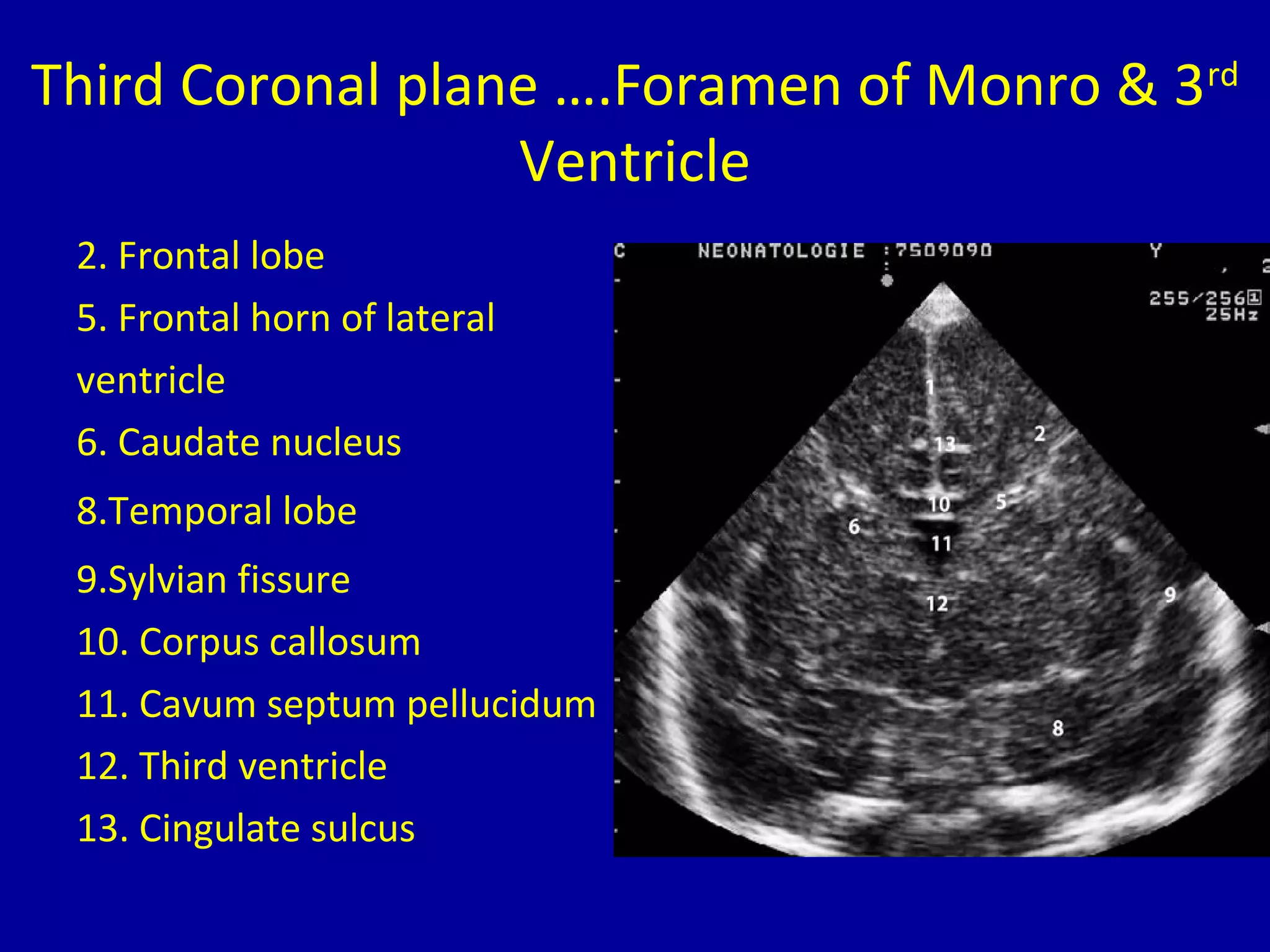 Cranial Ultrasound of neonate | PPT