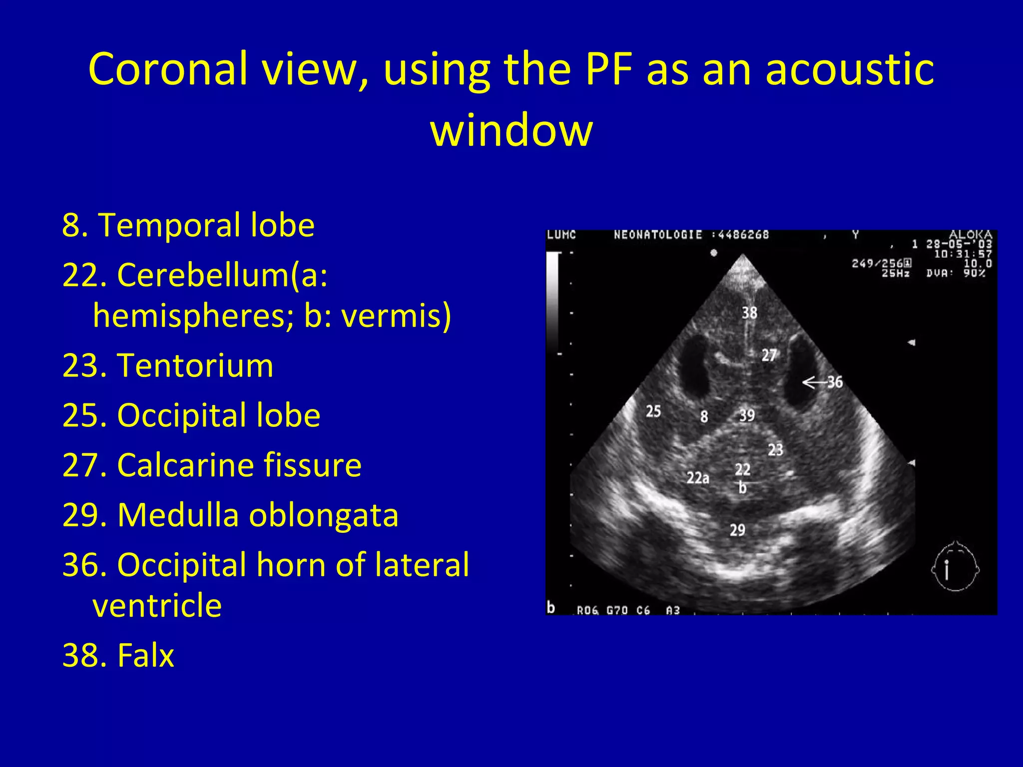 Cranial Ultrasound of neonate | PPT