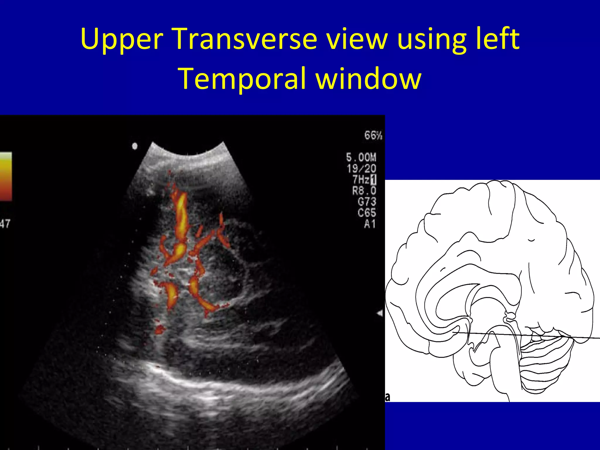 Cranial Ultrasound of neonate | PPT