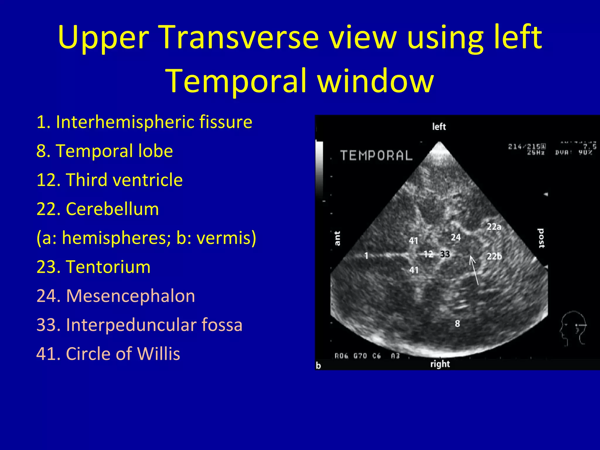 Cranial Ultrasound of neonate | PPT