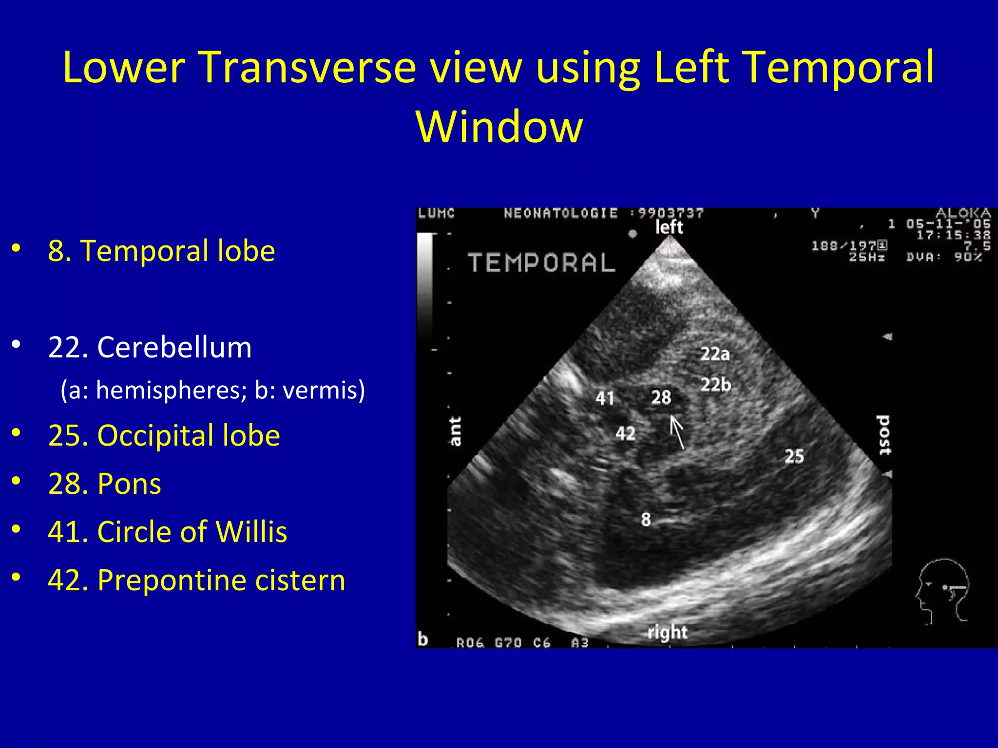 Cranial Ultrasound of neonate | PPT