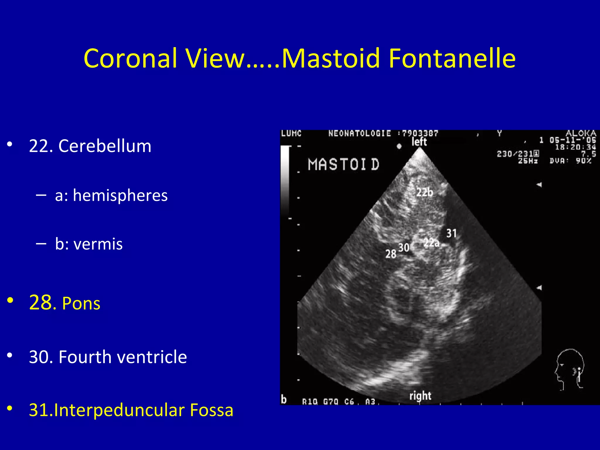 Cranial Ultrasound of neonate | PPT