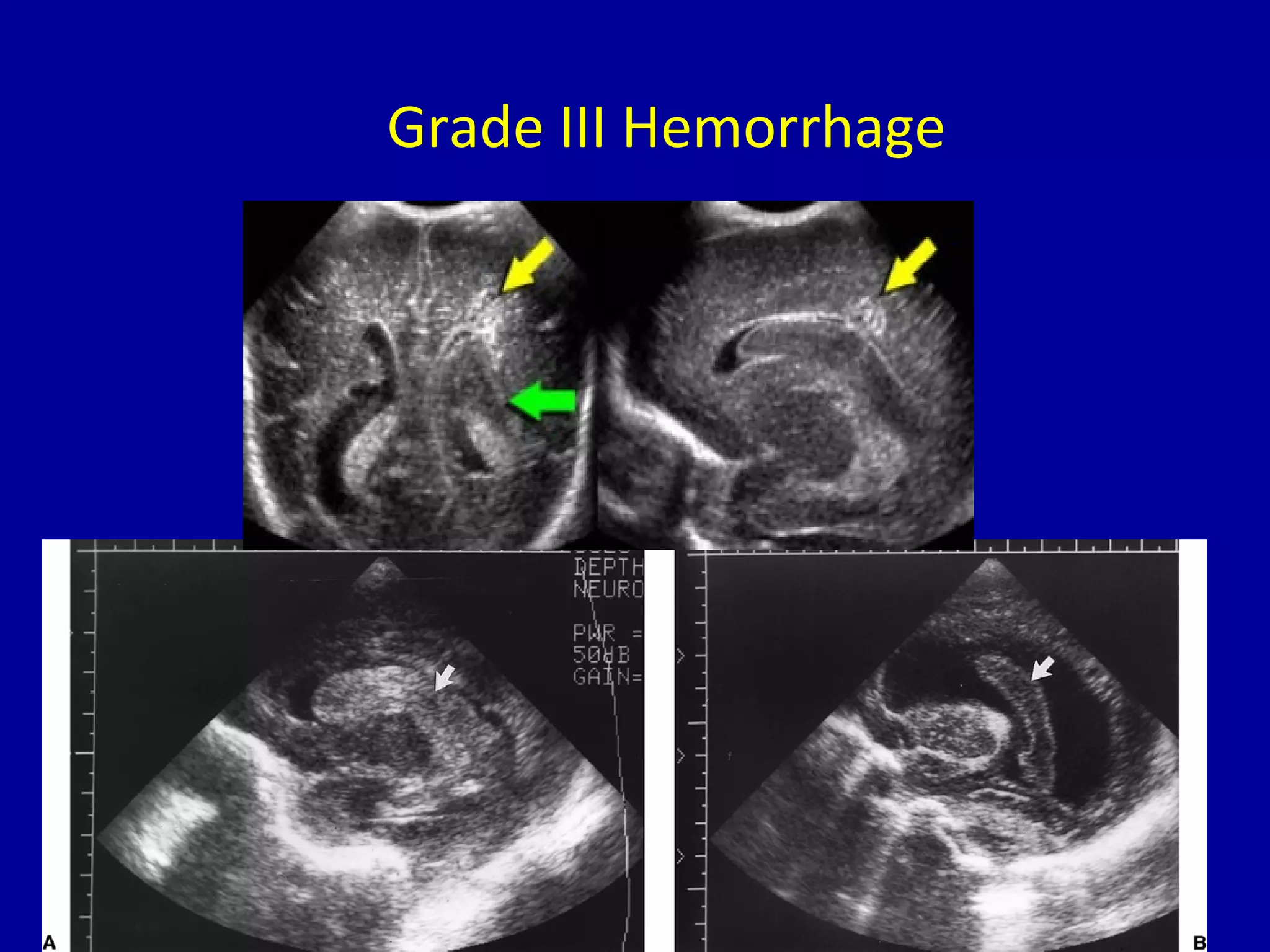 Cranial Ultrasound of neonate | PPT