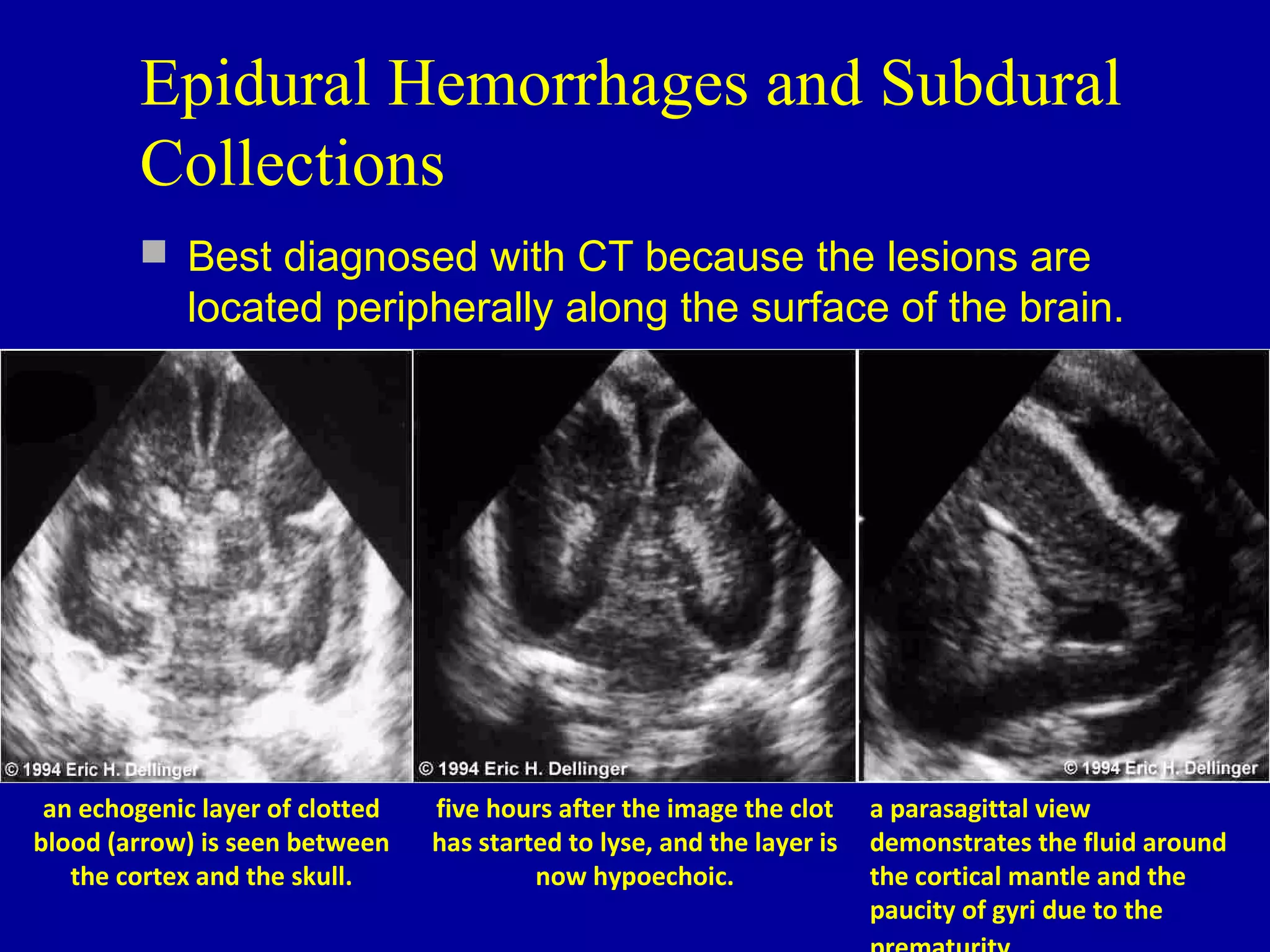 Cranial Ultrasound of neonate | PPT