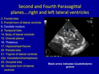 Cranial Ultrasound of neonate | PPT