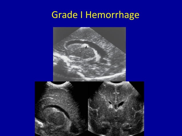 Cranial Ultrasound of neonate | PPT | Brain and Nervous System ...