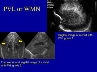 Cranial Ultrasound of neonate | PPT