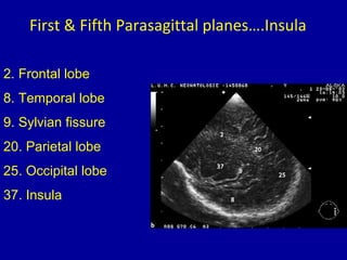 Normal Neonatal Head Ultrasound