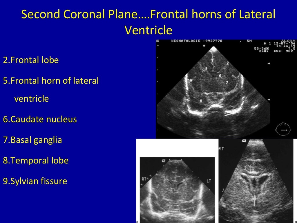 Cranial Ultrasound of neonate