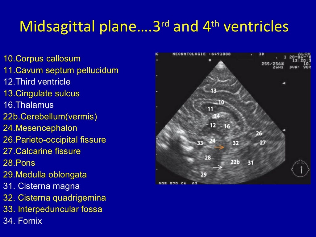 Cranial Ultrasound of neonate