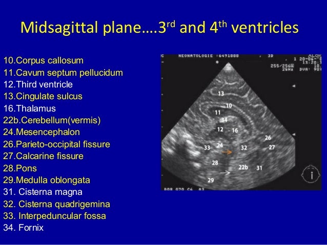 Cranial Ultrasound of neonate