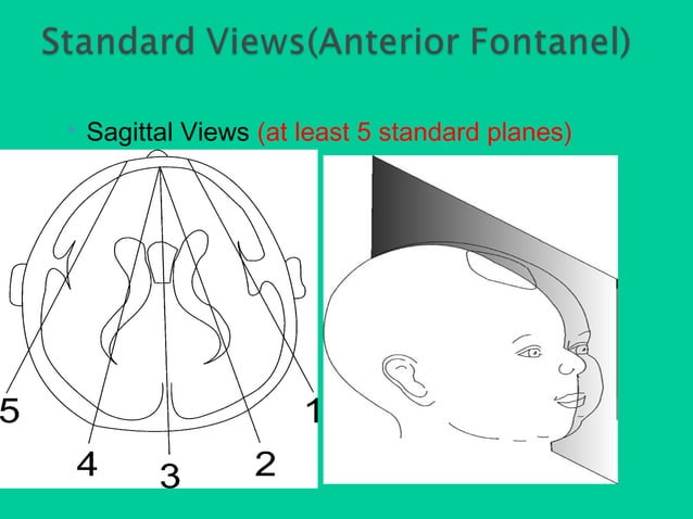 Neonatal cranial us from A to Z | PPT