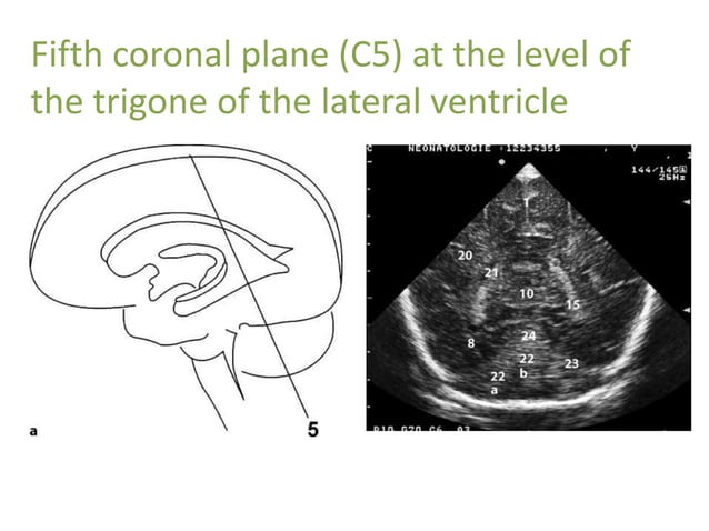 Neonatal transcranial USG | PPT | Medical Health