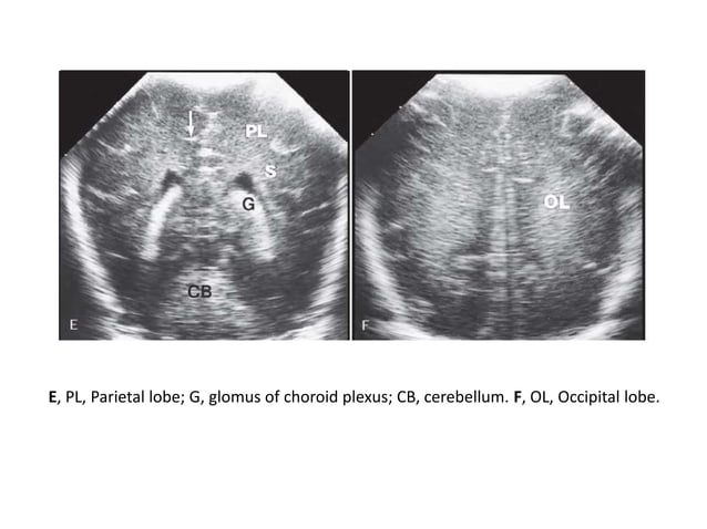 Neonatal transcranial USG | PPT | Medical Health