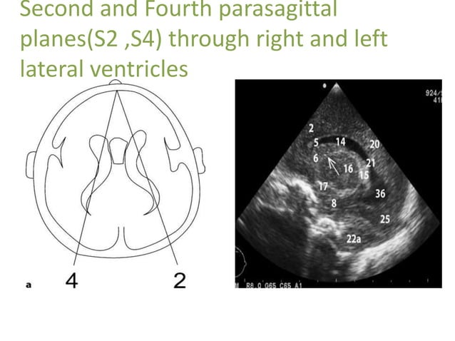 Neonatal transcranial USG | PPT | Medical Health