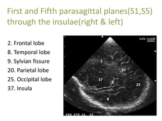 Neonatal transcranial USG | PPT