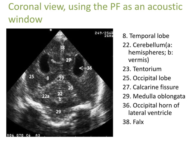 Neonatal transcranial USG | PPT | Medical Health