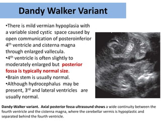 Dandy Walker Variant Ultrasound