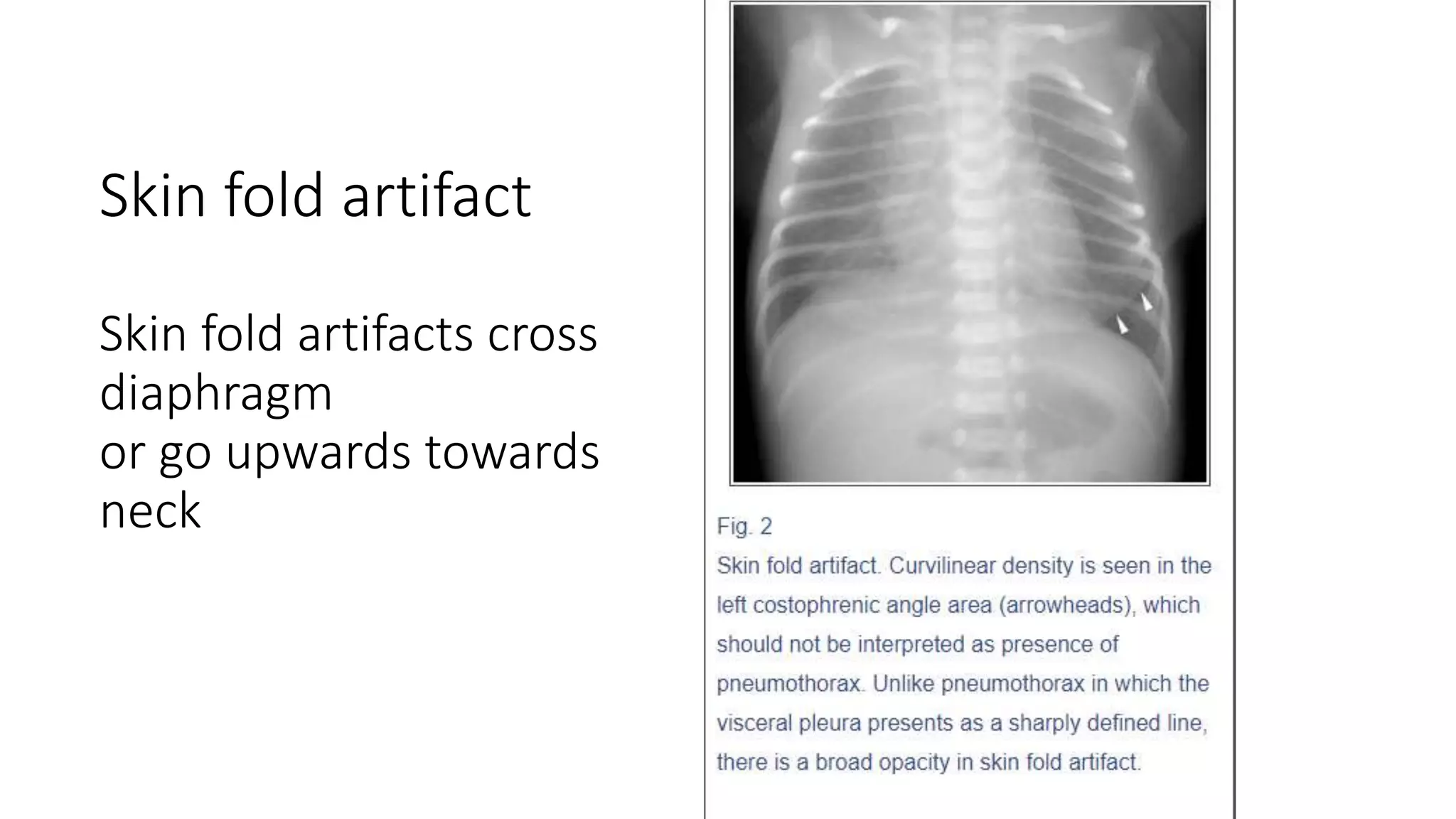 Neonatal Chest X-Ray | PPTX