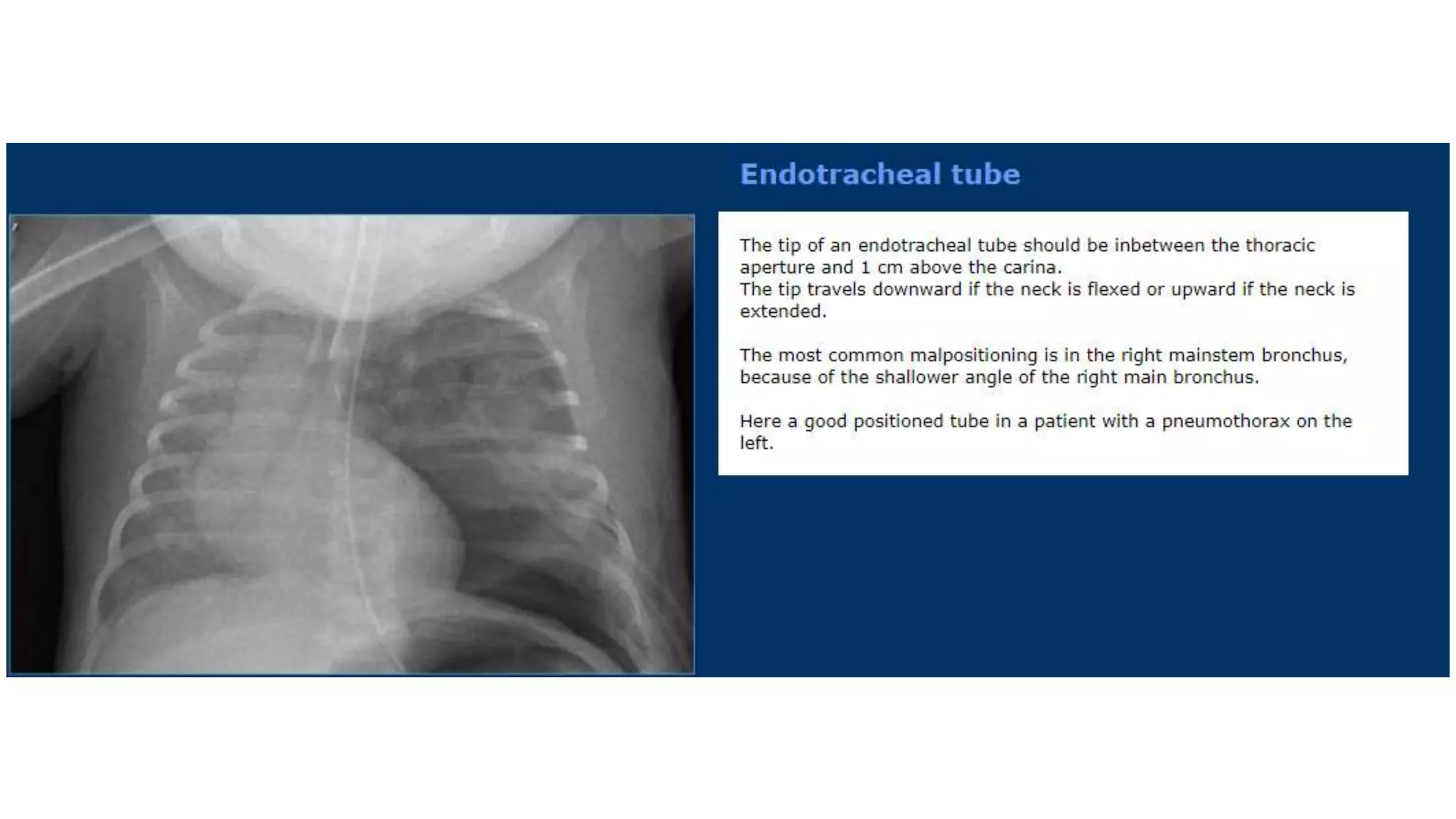 Neonatal Chest X-Ray | PPTX