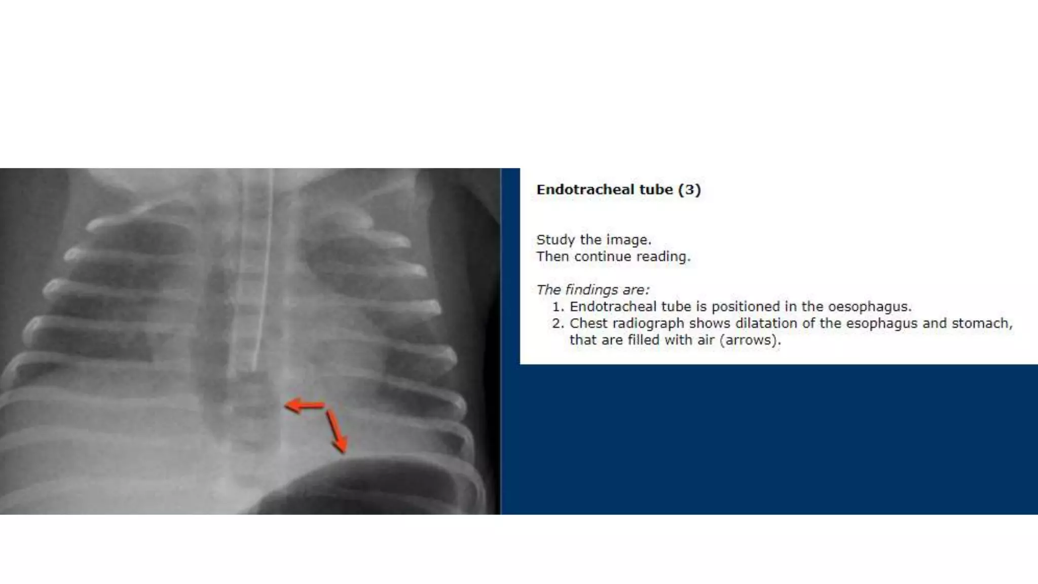 Neonatal Chest X-Ray | PPTX