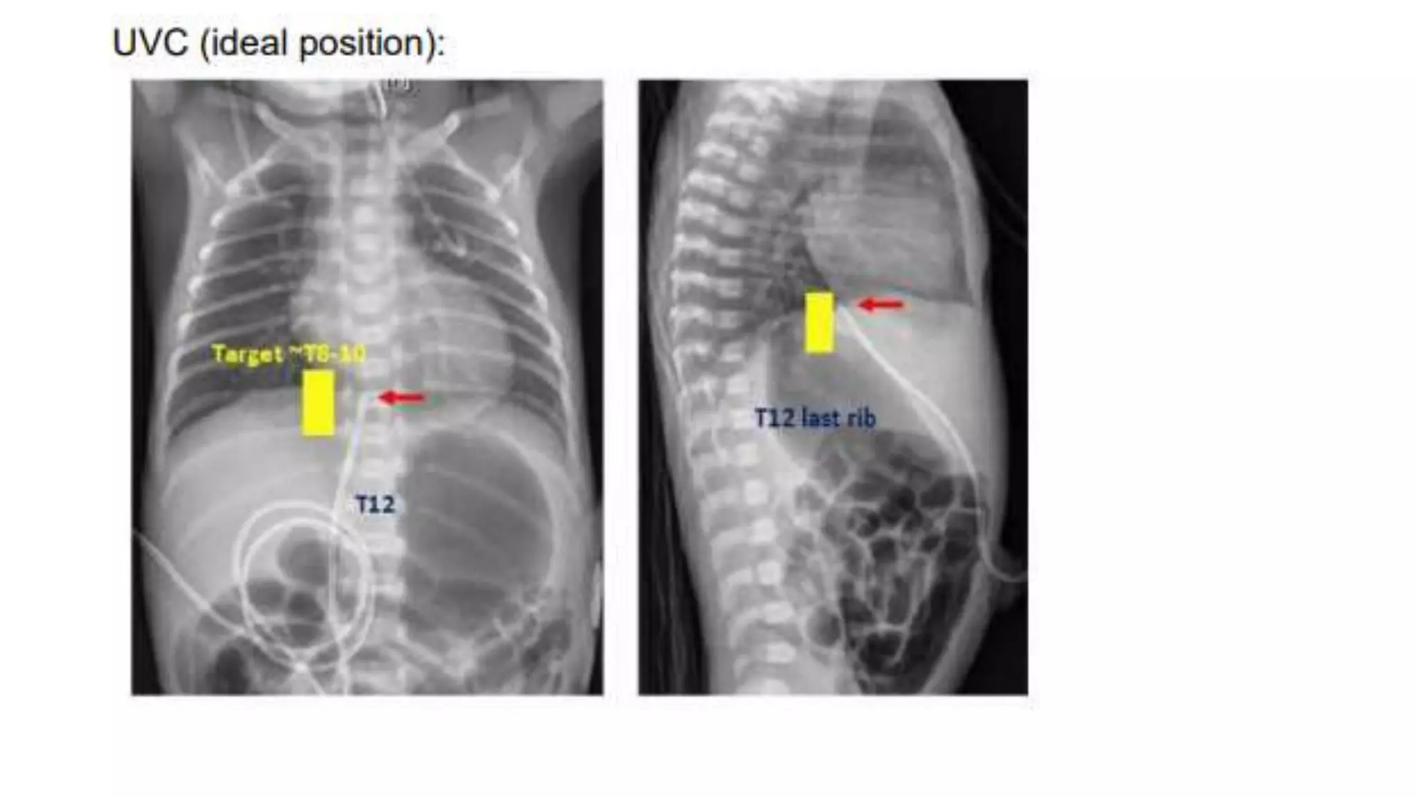 Neonatal Chest X-Ray | PPTX