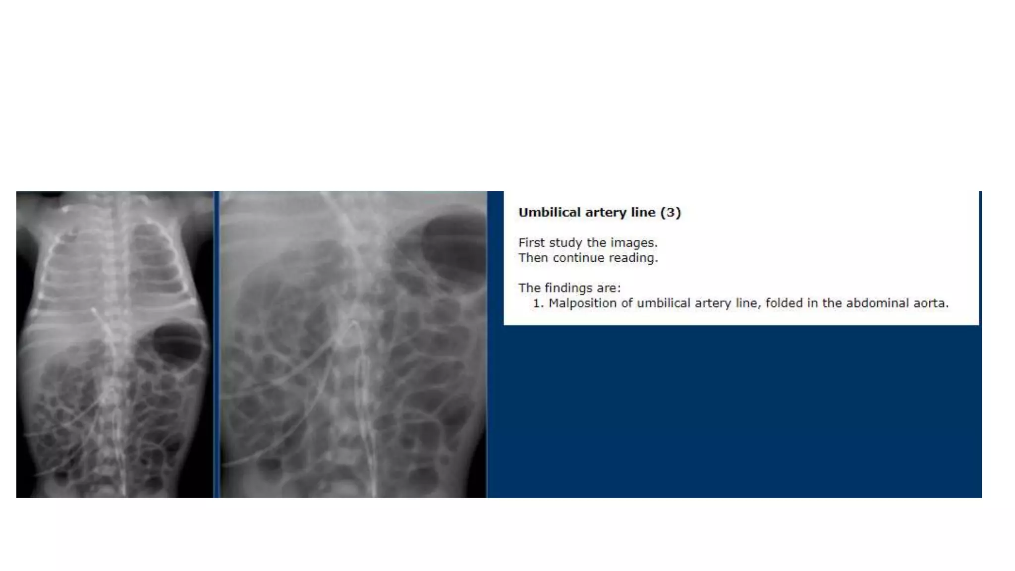 Neonatal Chest X-Ray | PPTX
