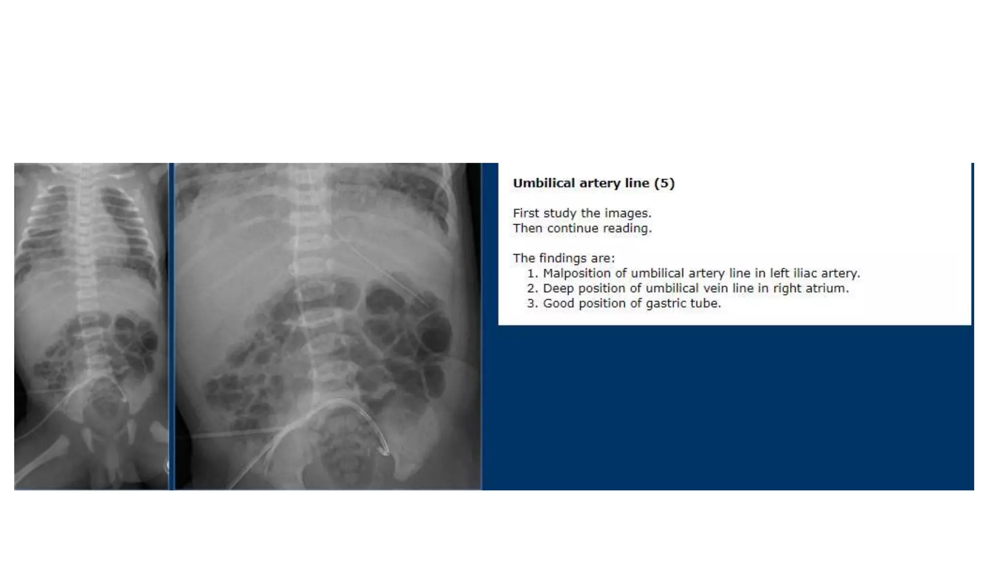 Neonatal Chest X-Ray | PPTX