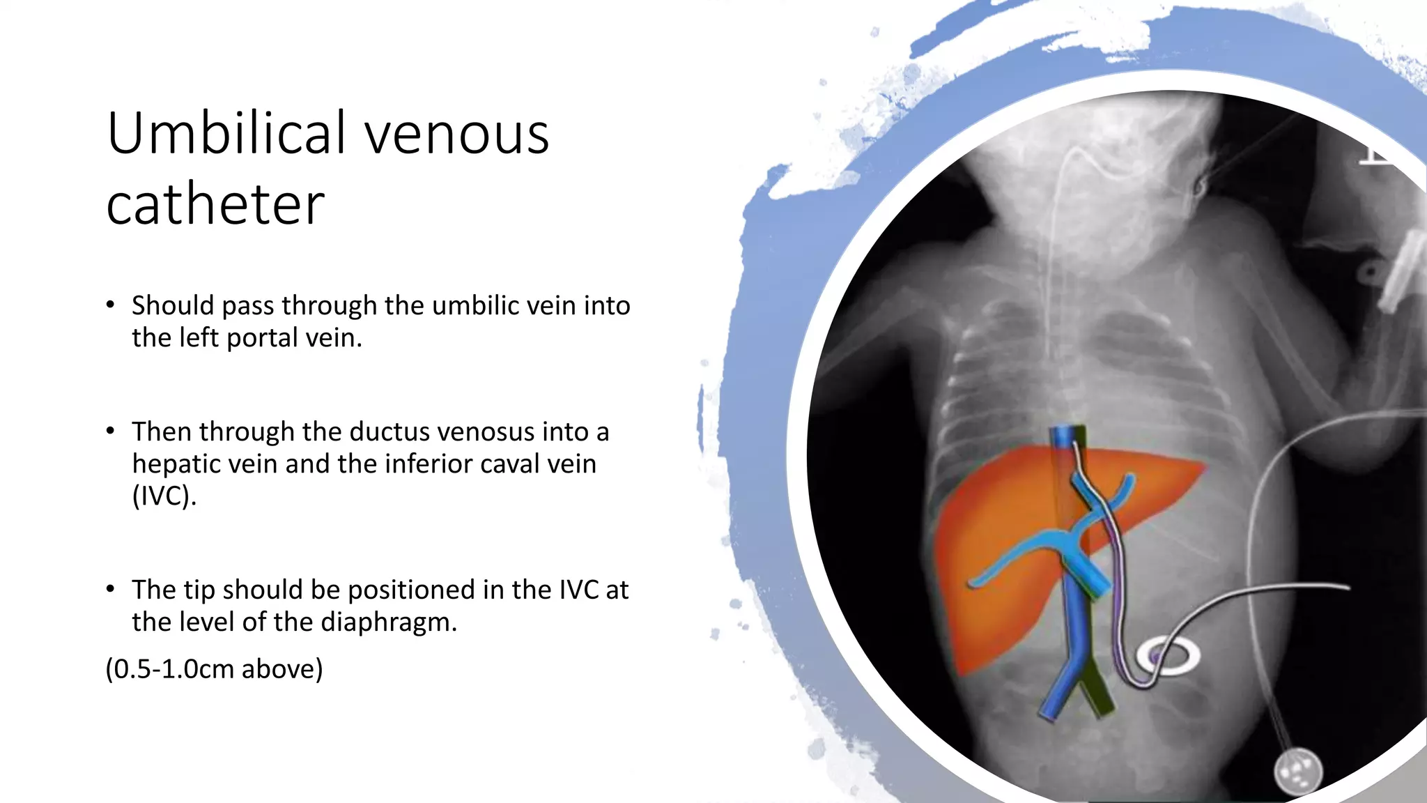 Neonatal Chest X-Ray | PPTX