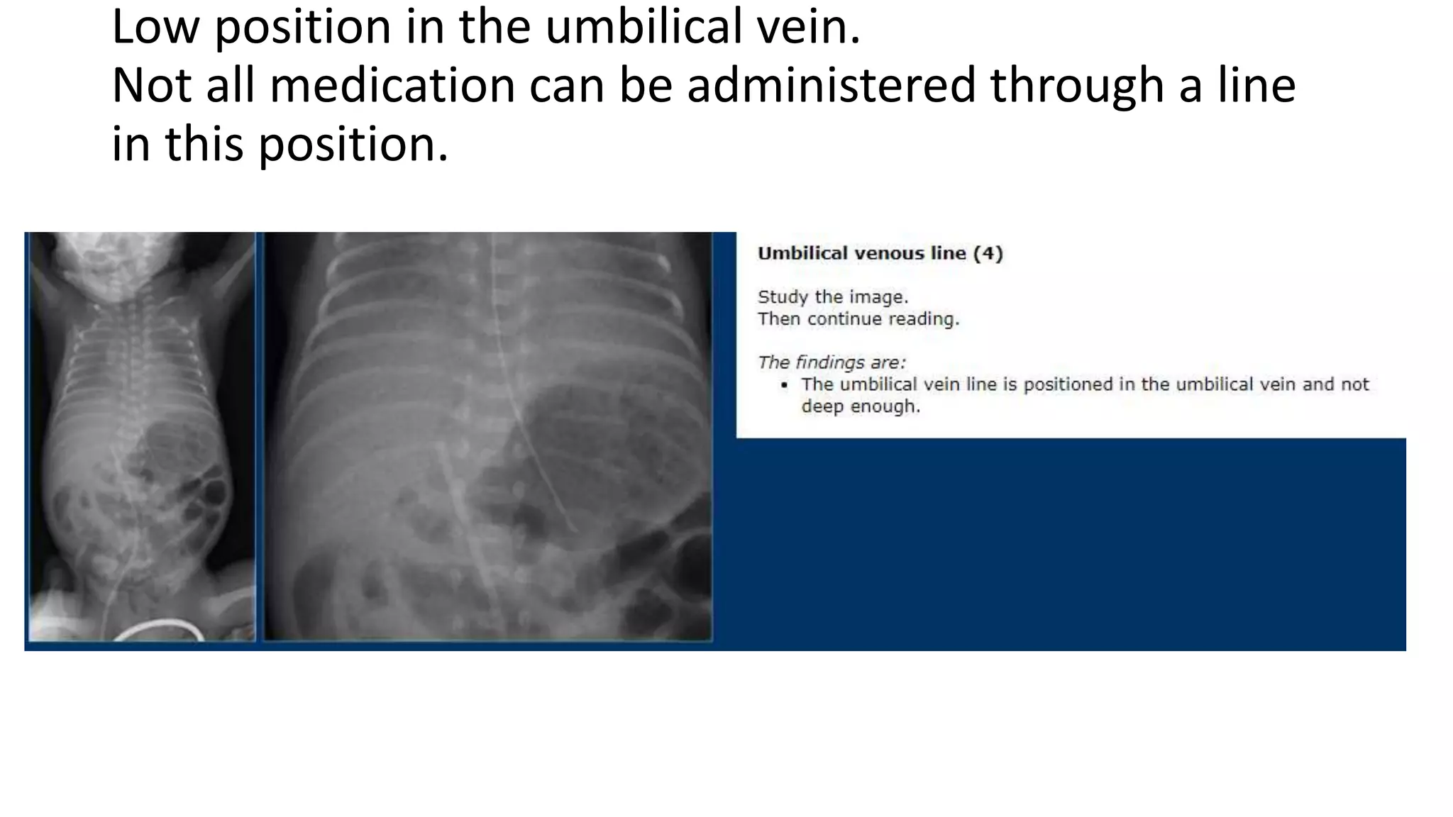 Neonatal Chest X-Ray | PPTX
