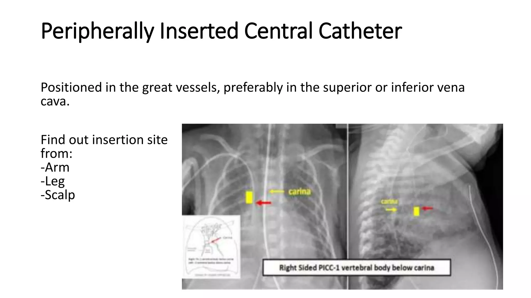 Neonatal Chest X-Ray | PPTX