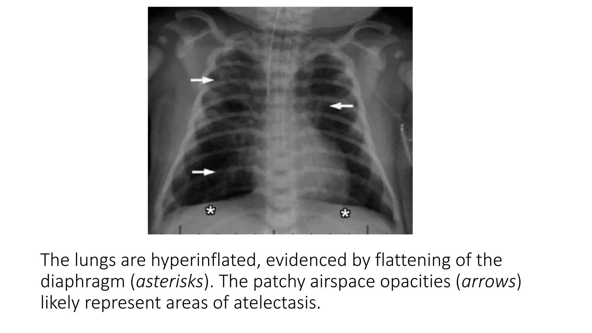 Neonatal Chest X-Ray | PPTX