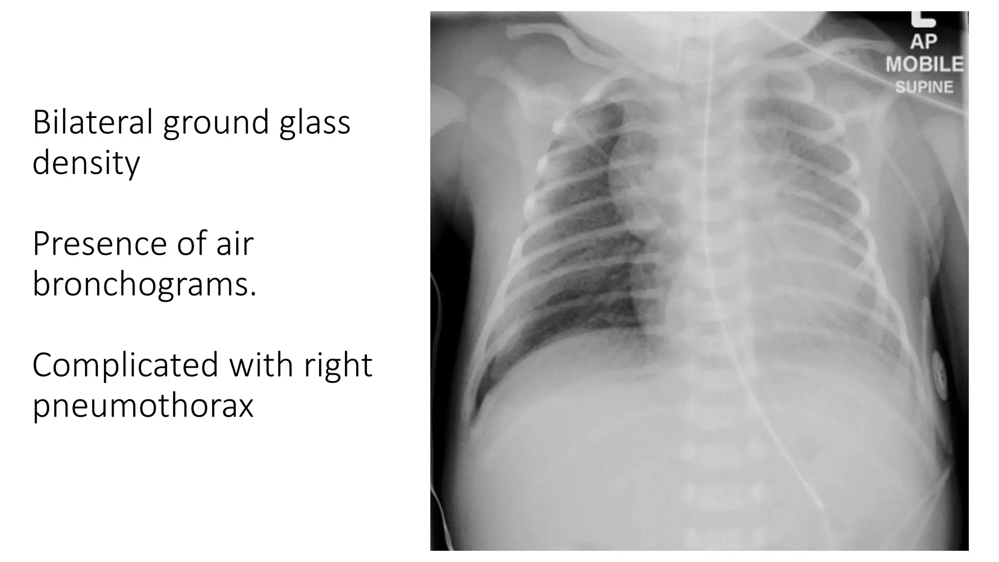 Neonatal Chest X-Ray | PPTX