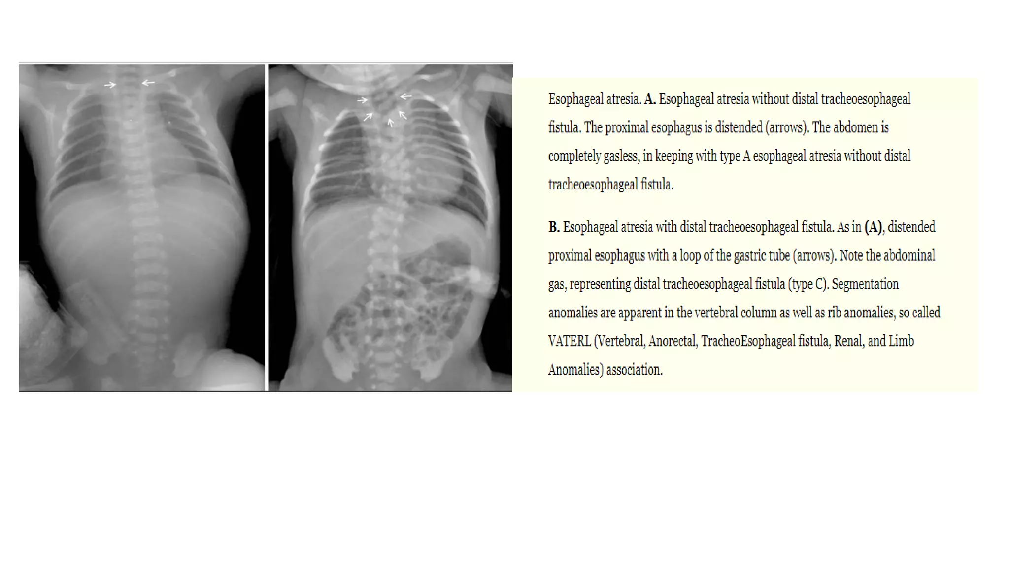 Neonatal Chest X-Ray | PPTX