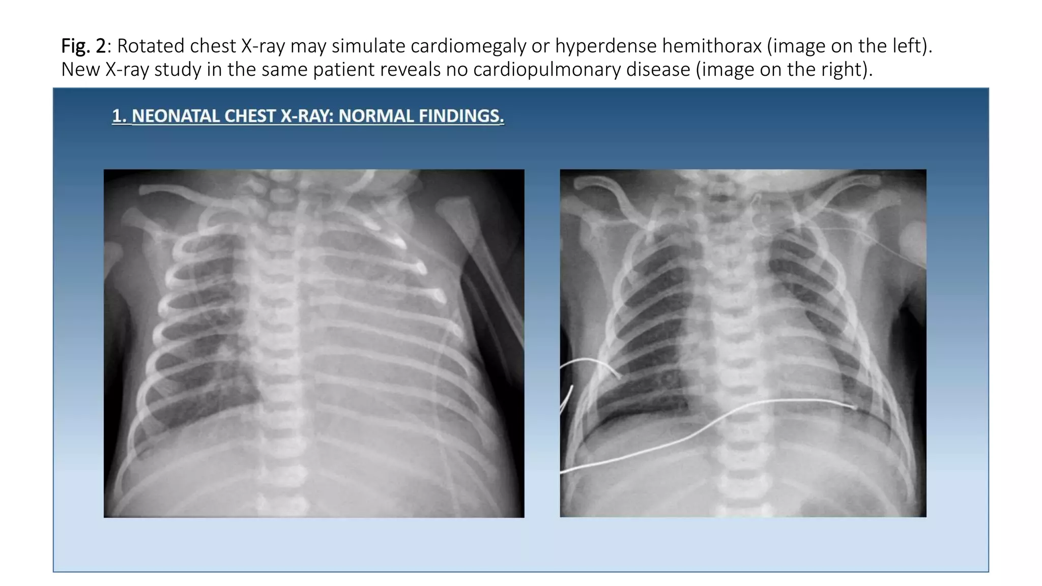 Neonatal Chest X-Ray | PPTX