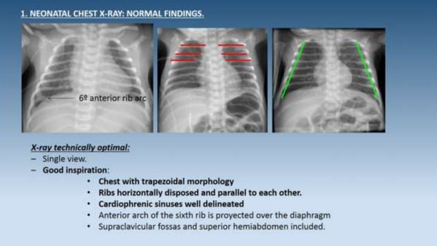 Neonatal Chest X-Ray | PPTX | Pregnancy | Reproductive Health