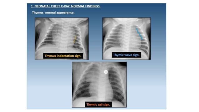 Neonatal Chest X-Ray | PPTX | Pregnancy | Reproductive Health