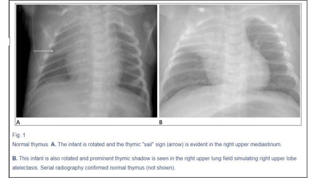 Neonatal Chest X-Ray | PPTX | Pregnancy | Reproductive Health