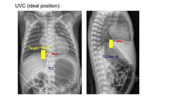 Neonatal Chest X-Ray | PPTX | Pregnancy | Reproductive Health