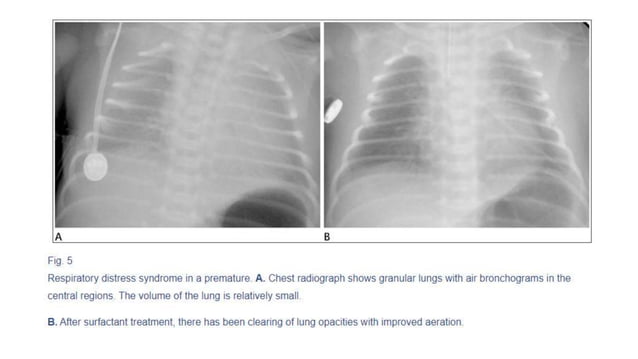 Neonatal Chest X-Ray | PPTX | Pregnancy | Reproductive Health