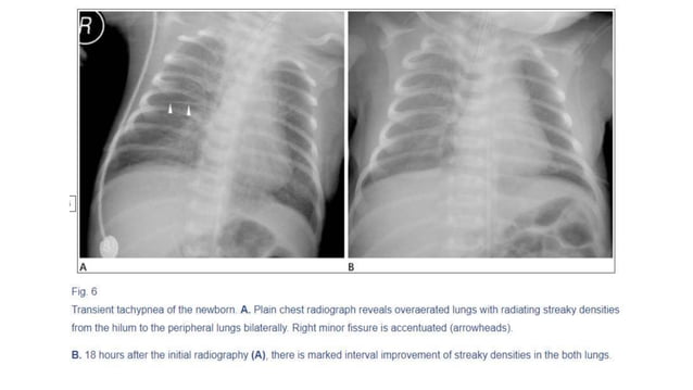 Neonatal Chest X-Ray | PPTX | Pregnancy | Reproductive Health