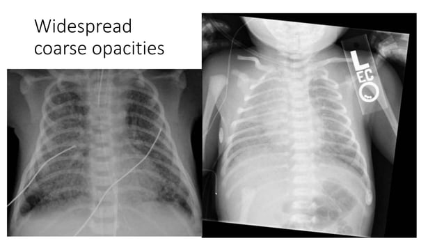 Neonatal Chest X-Ray | PPTX | Pregnancy | Reproductive Health